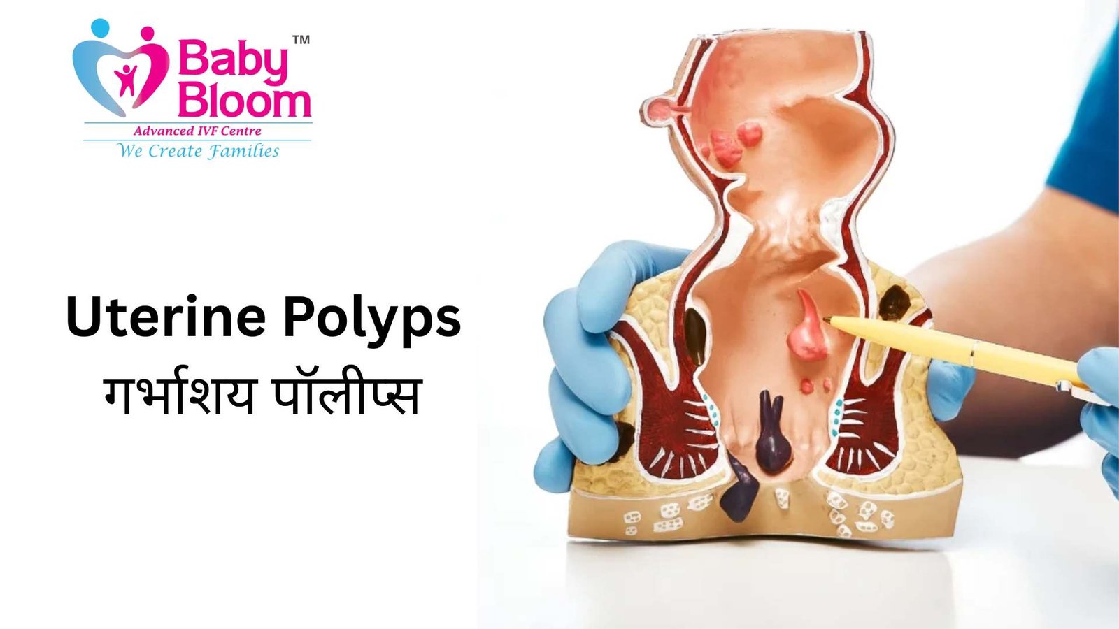 Uterine Polyps: Causes, Symptoms, Diagnosis & Treatment - BabyBloom IVF
